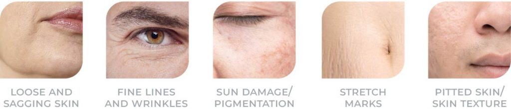 3D Dermaforce RF Microneedling - Horizon Laser Aesthetics Harrogate